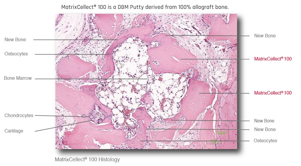 MatrixCellect® 100 DBM Putty, 5.0cc Syringe- ritterimplants