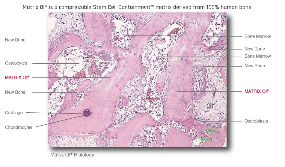 Matrix OI® Filler, 2-6mm, 2.5cc, Jar- ritterimplants