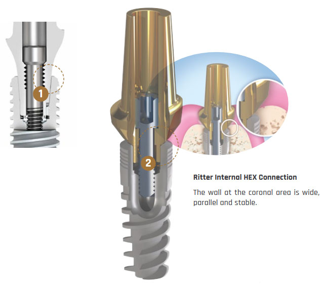 Titan Dental Implant-spiral-sbla-3.75mm-l-10mm